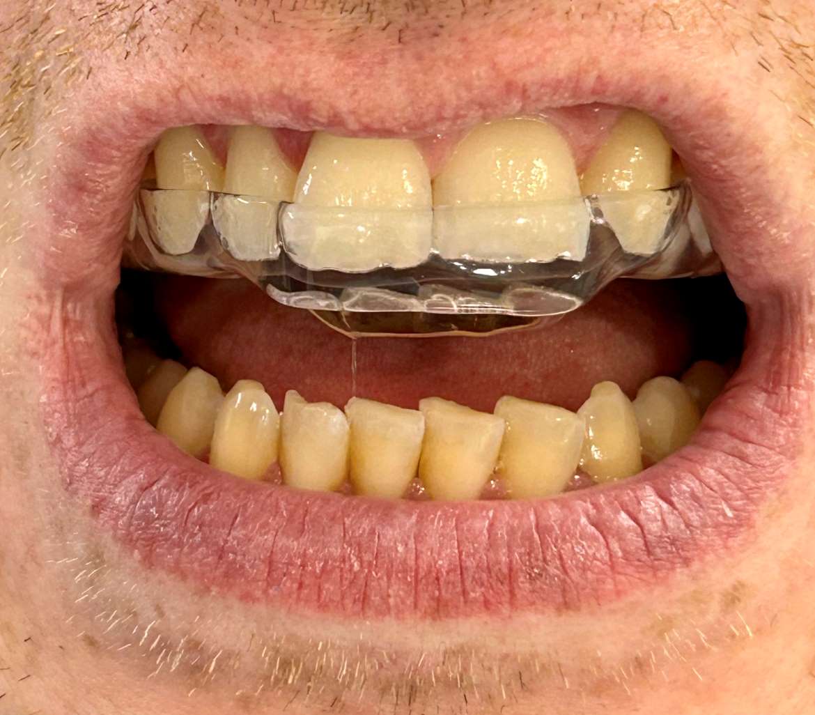 Upper Occlusal Splints Tmj Upper Occlusal Splints Tmj