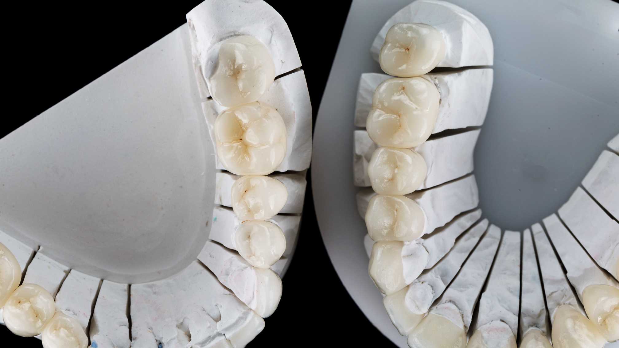 What are the different types of Crowns and Bridges? - London Specialist ...
