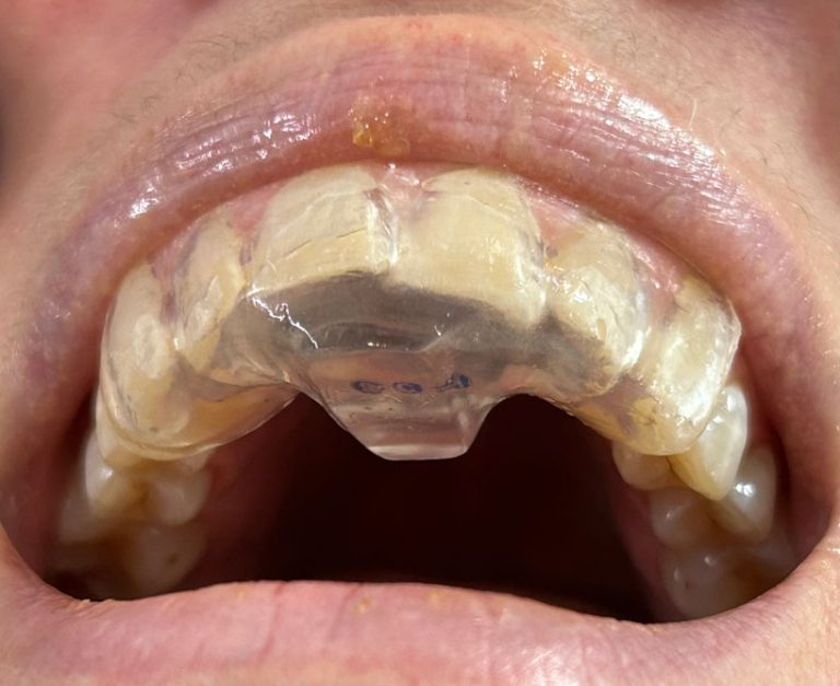 What Occlusal Splints and Michigan Splints Are and When they may be ...