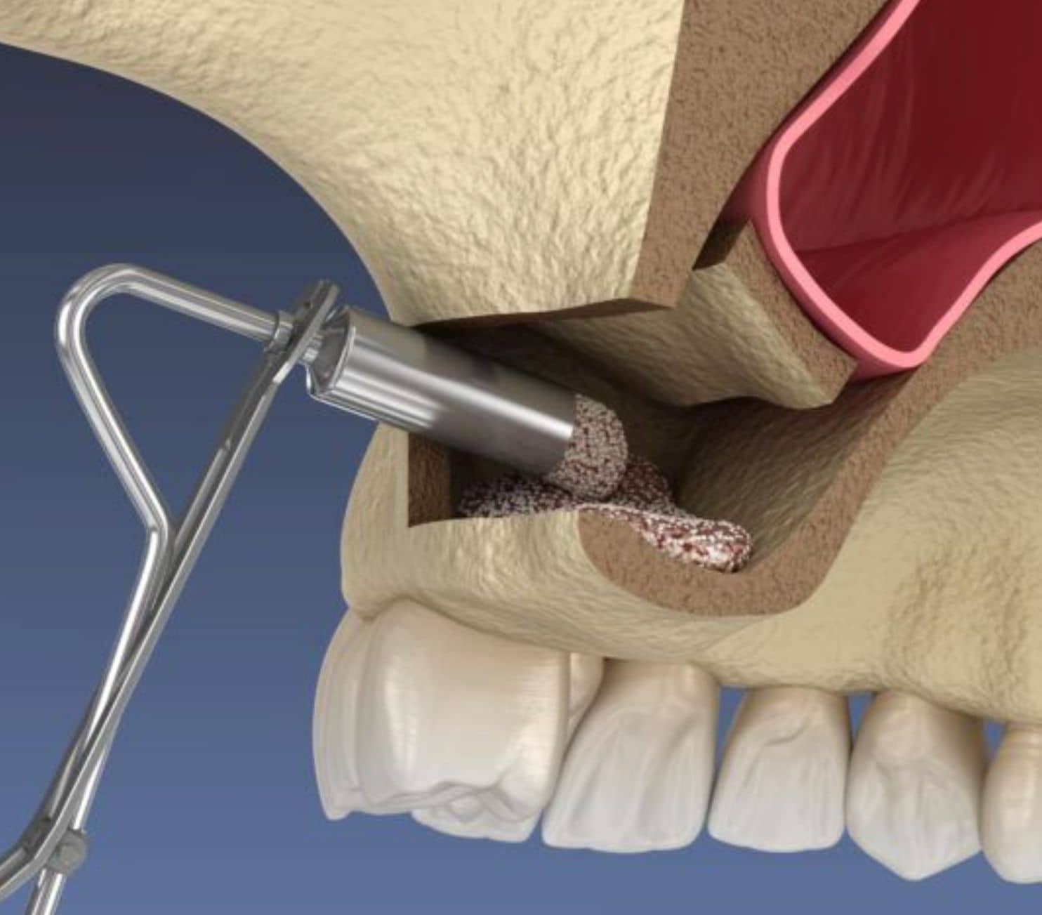 Sinus Floor Elevation - London Specialist Dentists