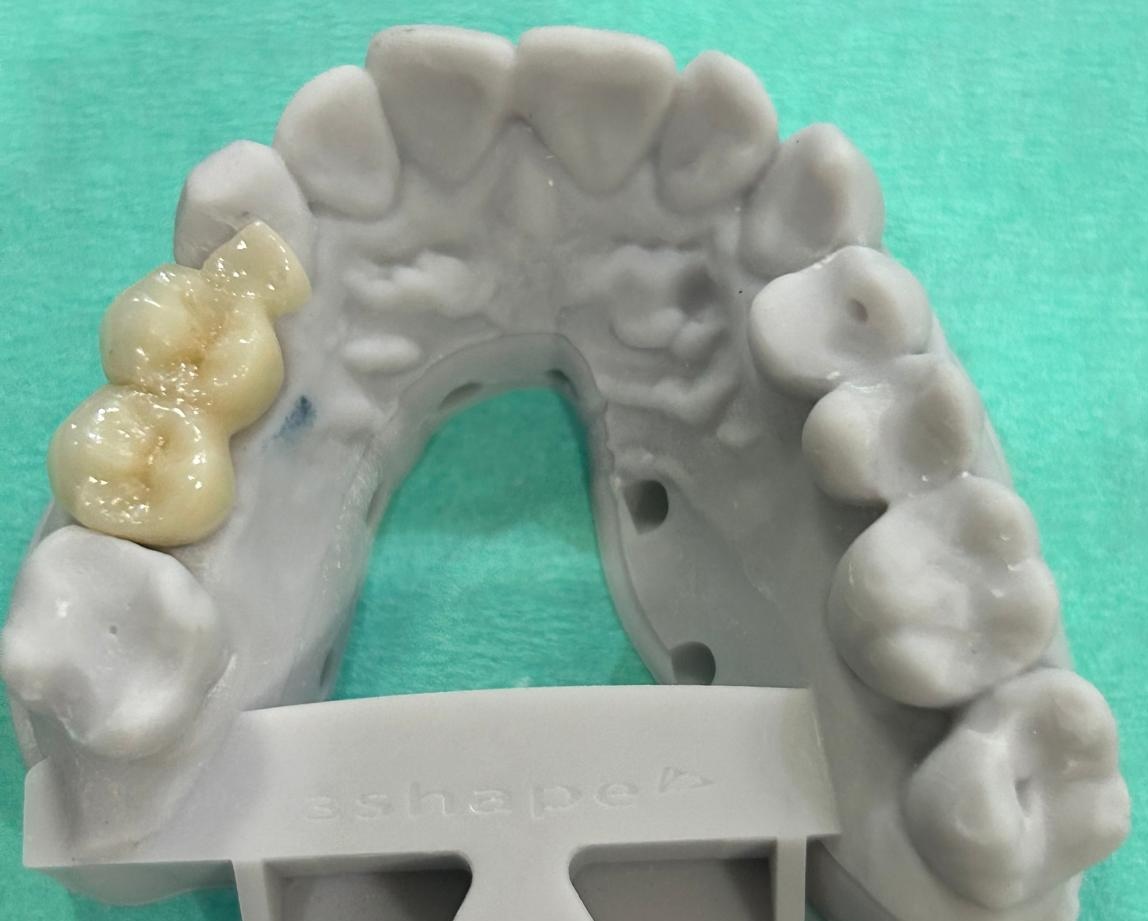 Resin Bonded Maryland Bridge - London Specialist Dentists